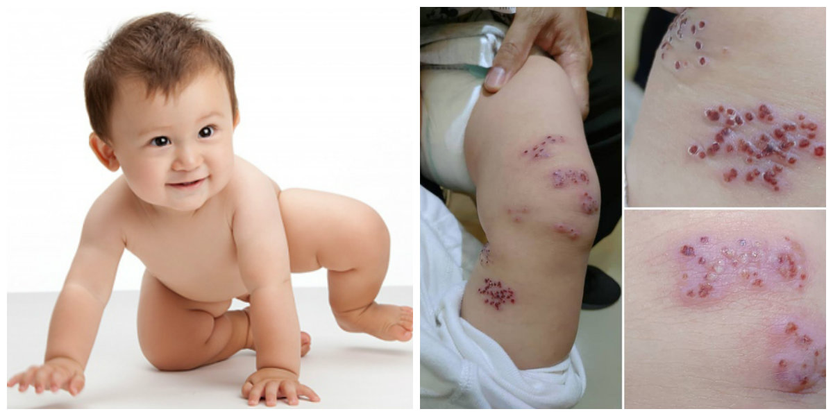 Bé 1 tuổi nổi mụn nước chi chít vô cùng đáng sợ, sự thật đằng sau khiến ...
