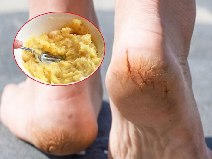 Cách trị nứt nẻ gót chân bằng loạt công thức đơn giản, hiệu quả
